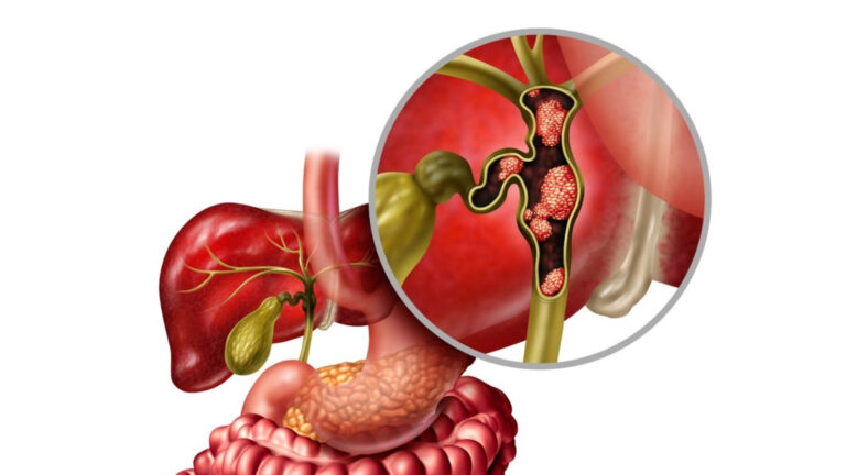 How To Cure Bile Duct Cancer (Cholangiocarcinoma) | AllCancer