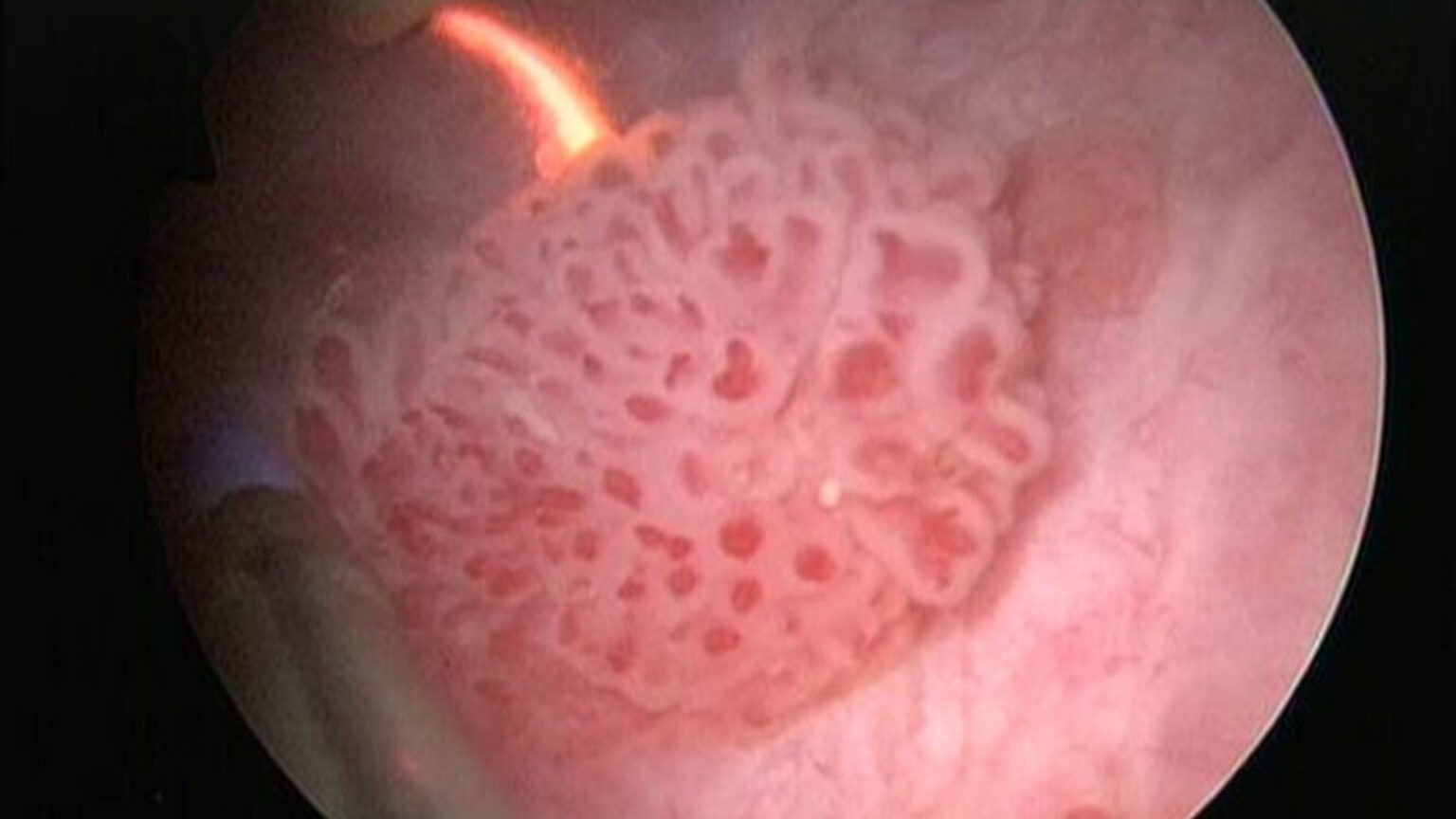 How To Cure Bladder Cancer (Urothelial Carcinoma Of The Bladder ...