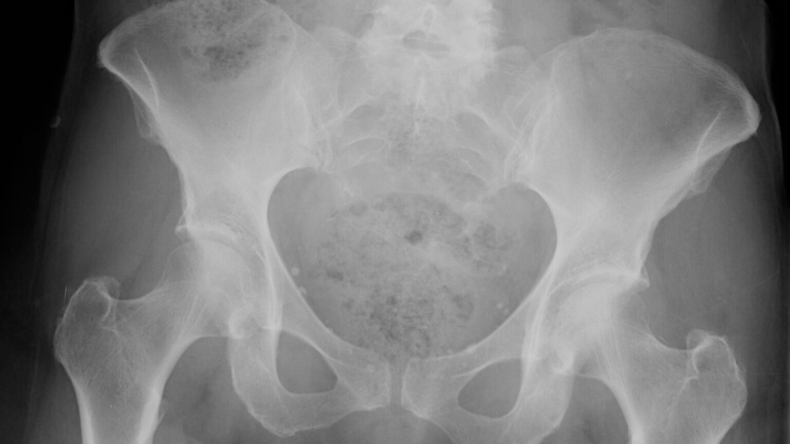 How To Cure Chordoma (Chordoid Bone Tumor) | AllCancer