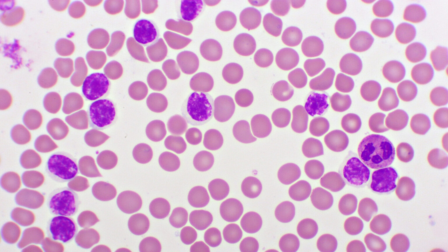 How To Cure Chronic Lymphocytic Leukemia (CLL) | AllCancer