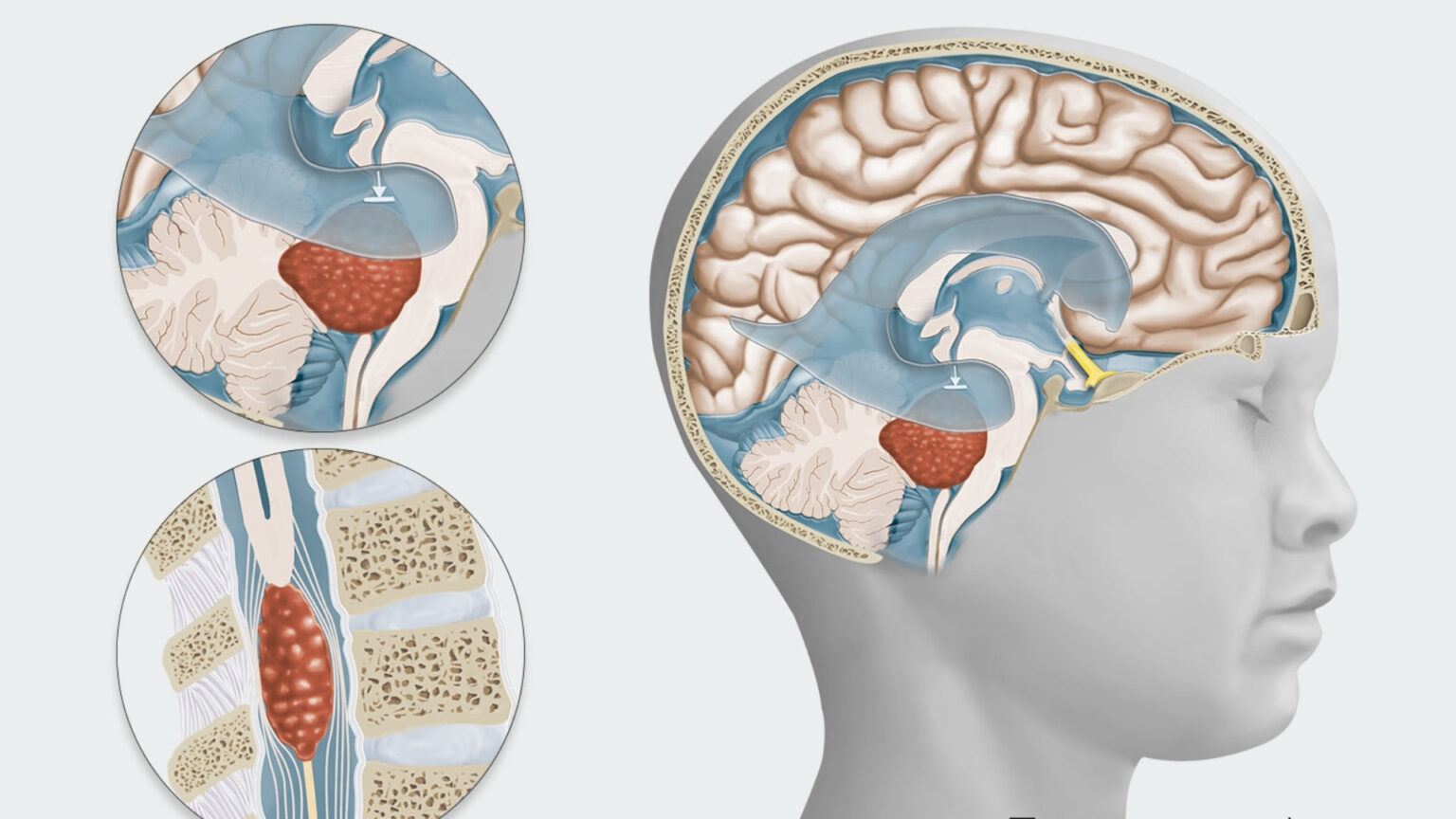 How To Cure Ependymoma (Ependymal Brain Tumor) | AllCancer