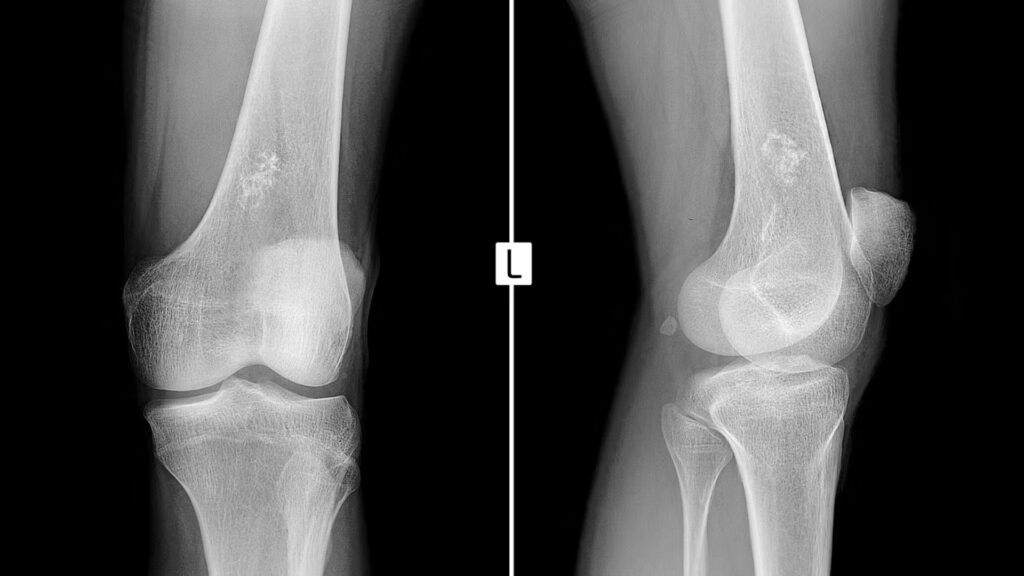 How To Cure Ewing Sarcoma (Bone Sarcoma) | AllCancer