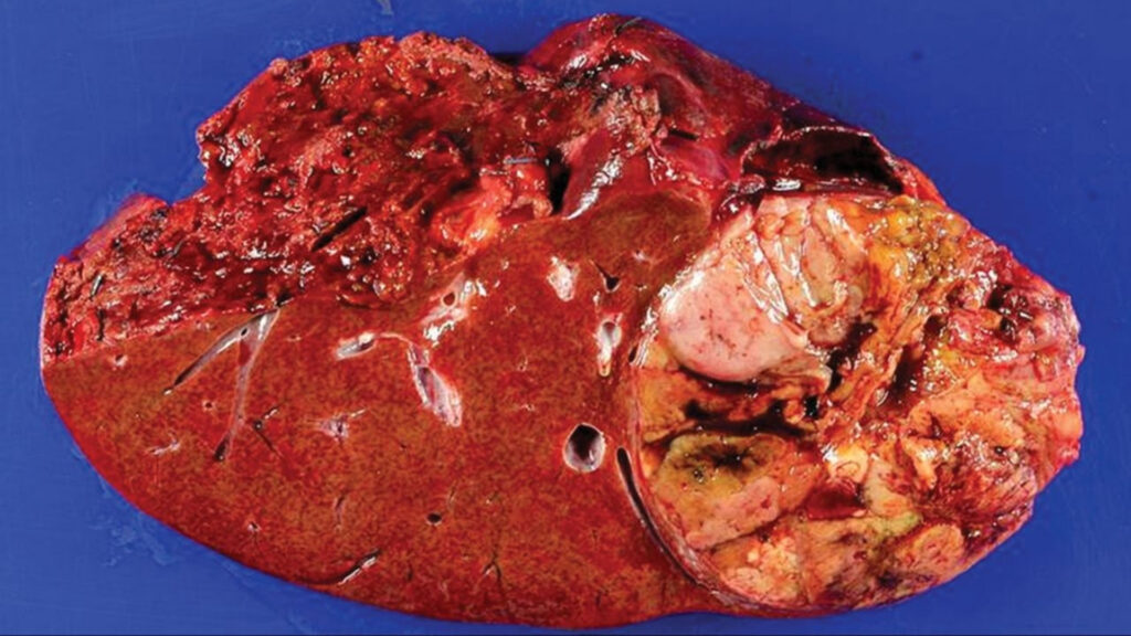 How To Cure Hepatocellular Carcinoma (Liver Cancer) | AllCancer