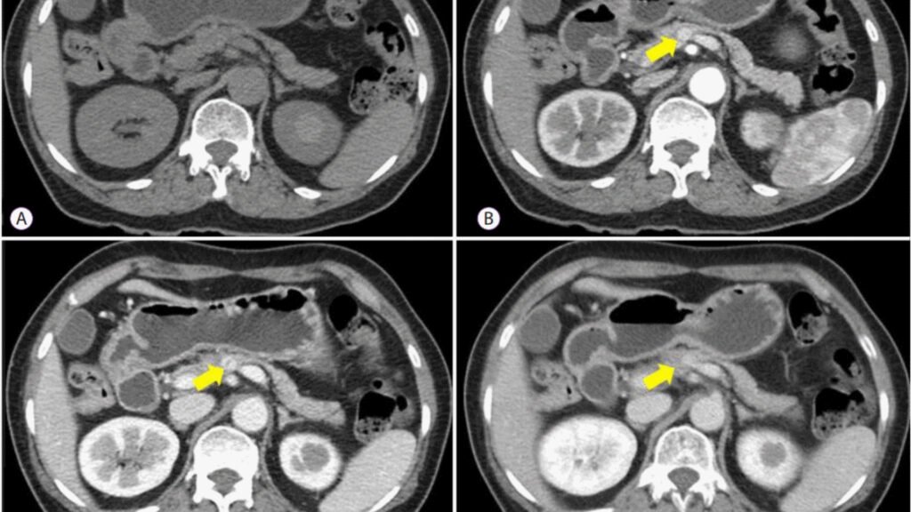 How To Cure Islet Cell Tumor (Pancreatic Neuroendocrine Tumor) | AllCancer