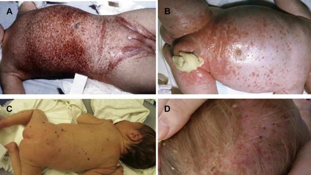 How To Cure Langerhans Cell Histiocytosis (LCH) | AllCancer