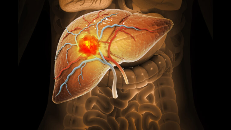 Liver Cancer (Hepatocellular Carcinoma) – AllCancer | #1 Cancer Cure Rate