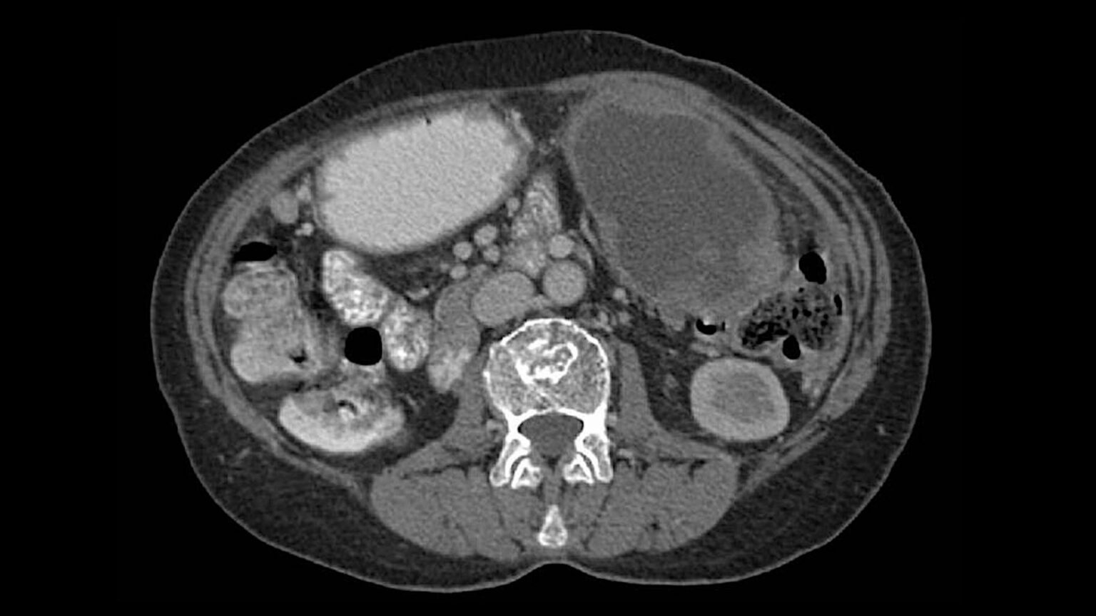 How To Cure Primary Peritoneal Cancer (Primary Peritoneal Carcinoma ...