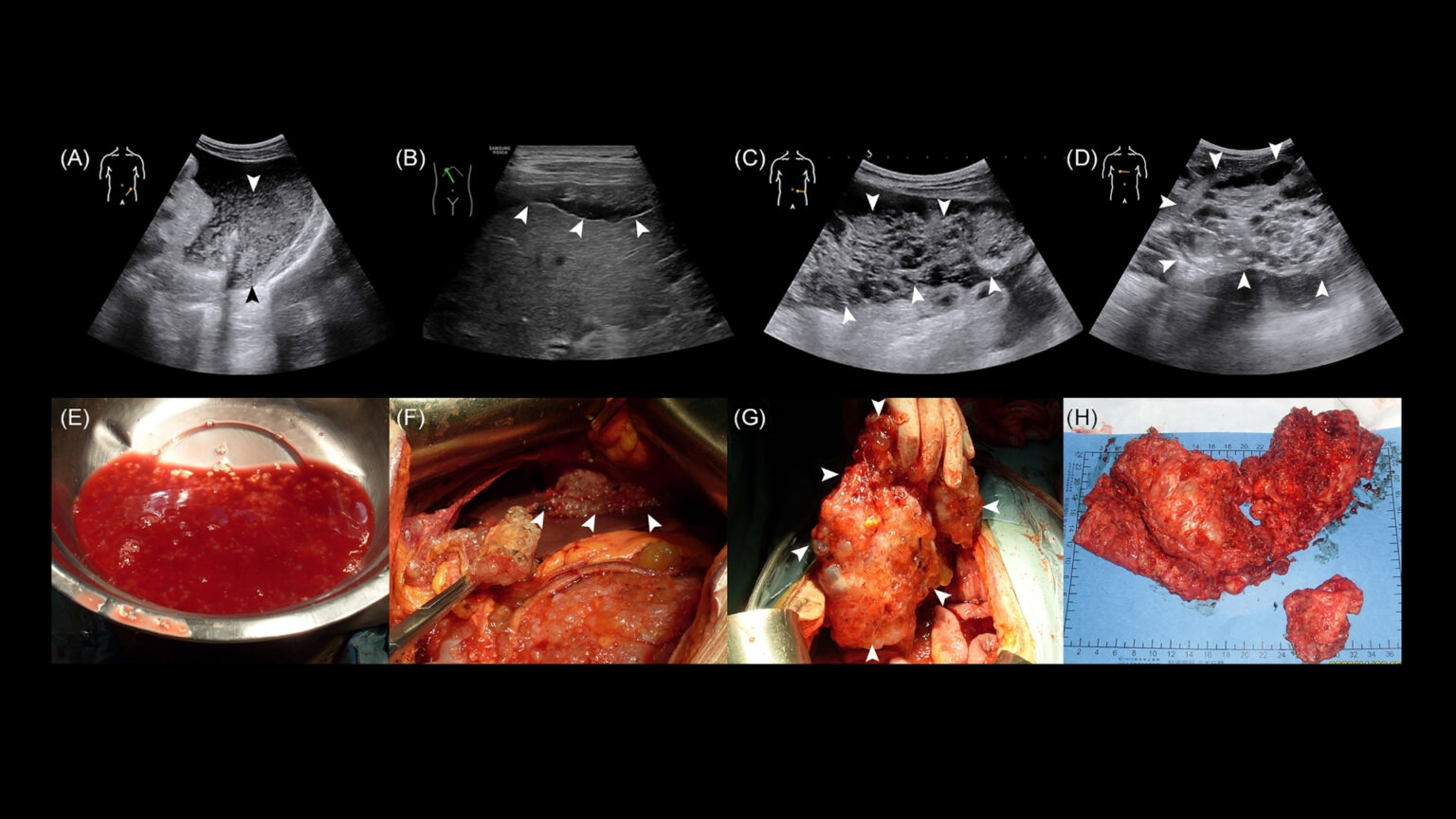 How To Cure Pseudomyxoma Peritonei (PMP) | AllCancer