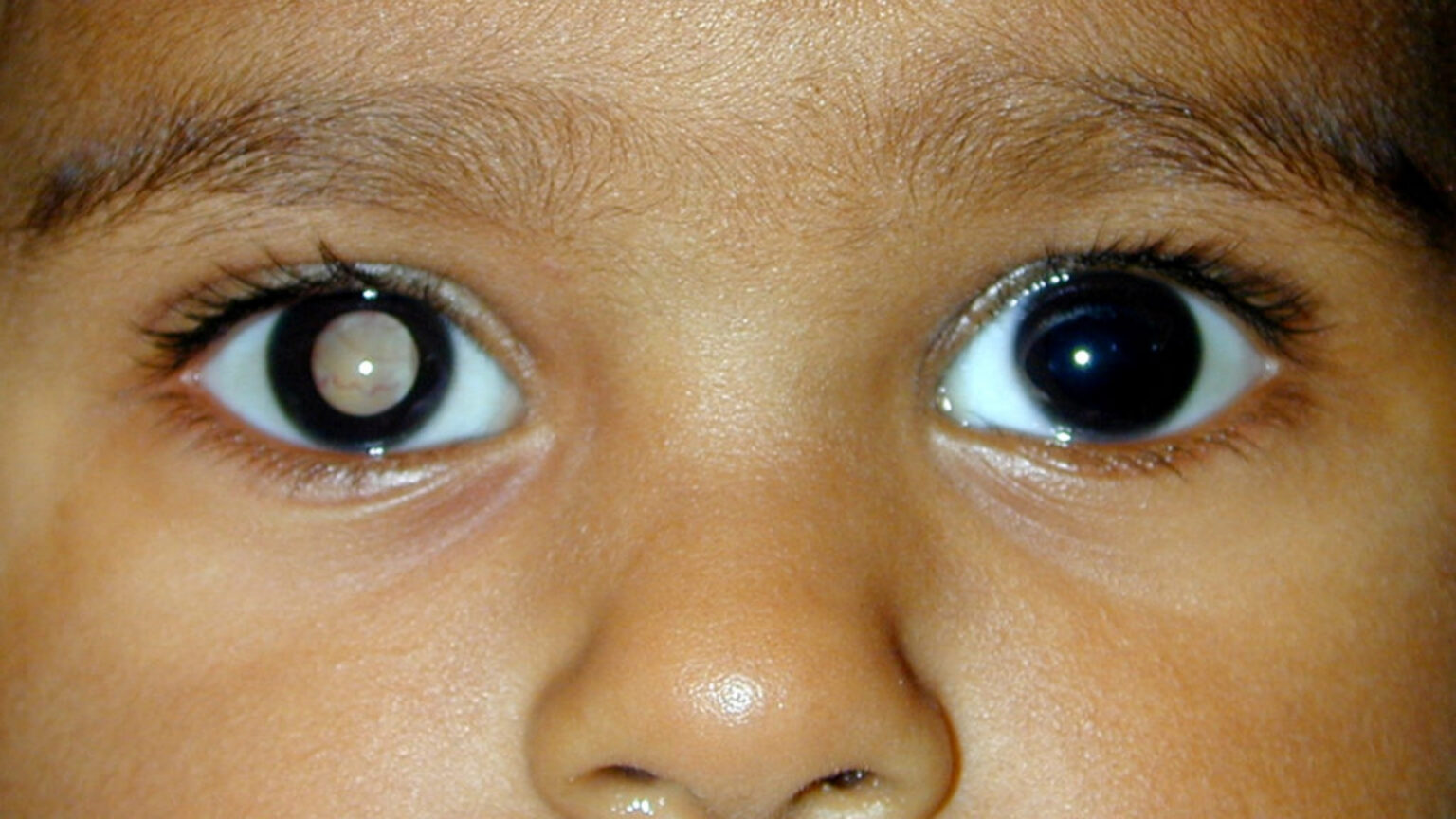 How To Cure Retinoblastoma (Retinal Cancer) | AllCancer
