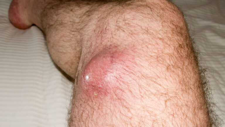 How To Cure Soft Tissue Sarcoma (STS) | AllCancer