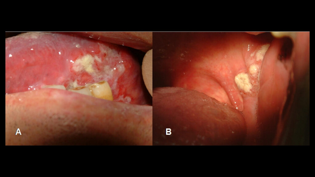 How To Cure Tonsil Cancer (Tonsillar Carcinoma) | AllCancer