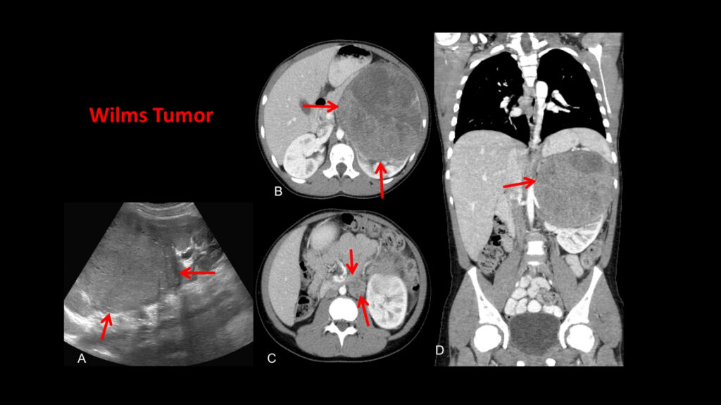 Understanding Wilms Tumor (Nephroblastoma) | AllCancer