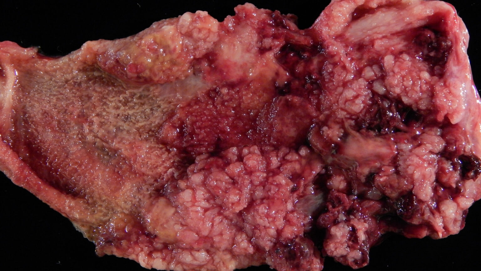 How To Cure Gallbladder Cancer (Gallbladder Carcinoma) | AllCancer