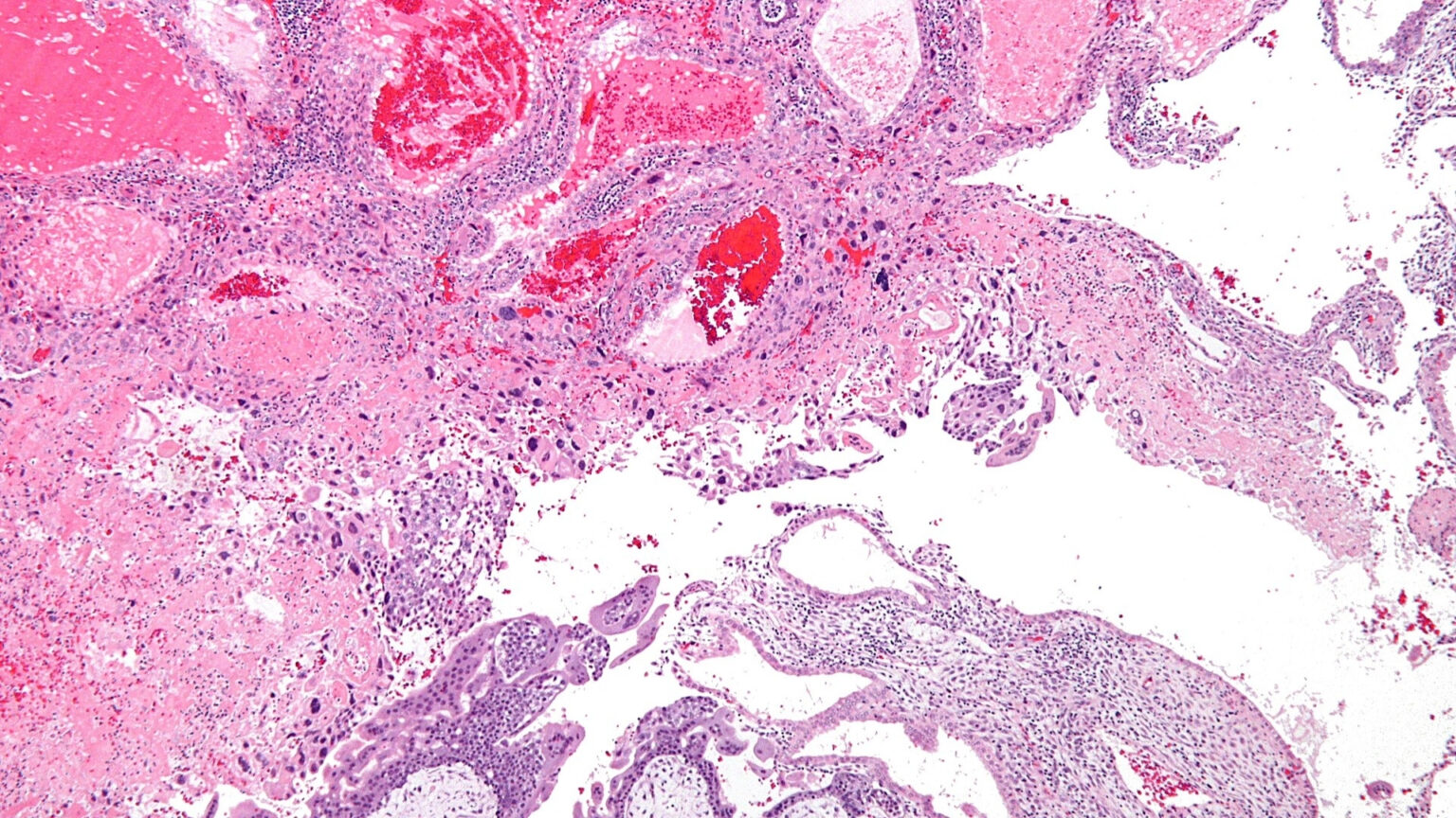 How To Cure Gestational Trophoblastic Disease (GTD) | AllCancer