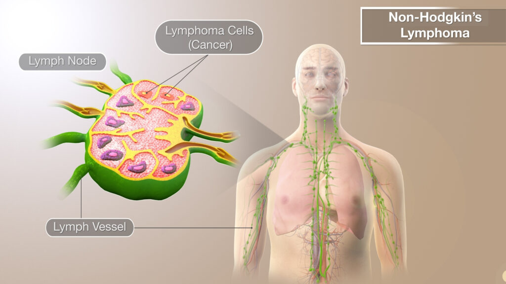 How To Cure Non-Hodgkin Lymphoma (NHL) | AllCancer