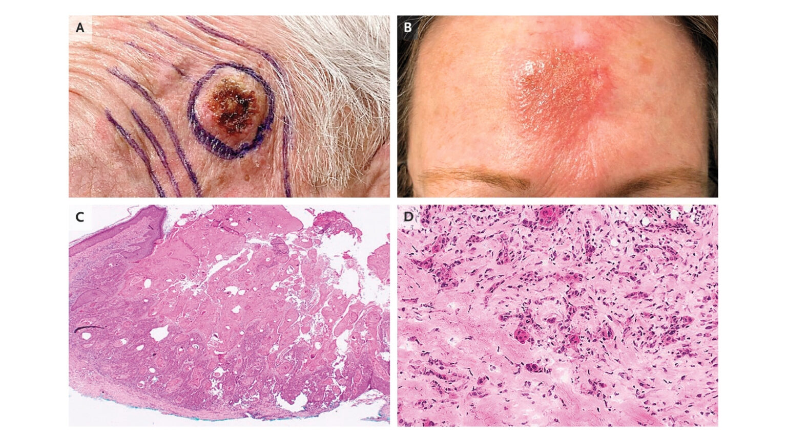 How To Cure Skin Cancer (Cutaneous Carcinoma) | AllCancer