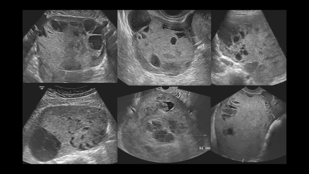 Understanding Yolk Sac Tumor (Endodermal Sinus Tumor) | AllCancer