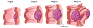 How I Knew I Had Colon Cancer: Real Stories, Symptoms, And Seeking Help ...